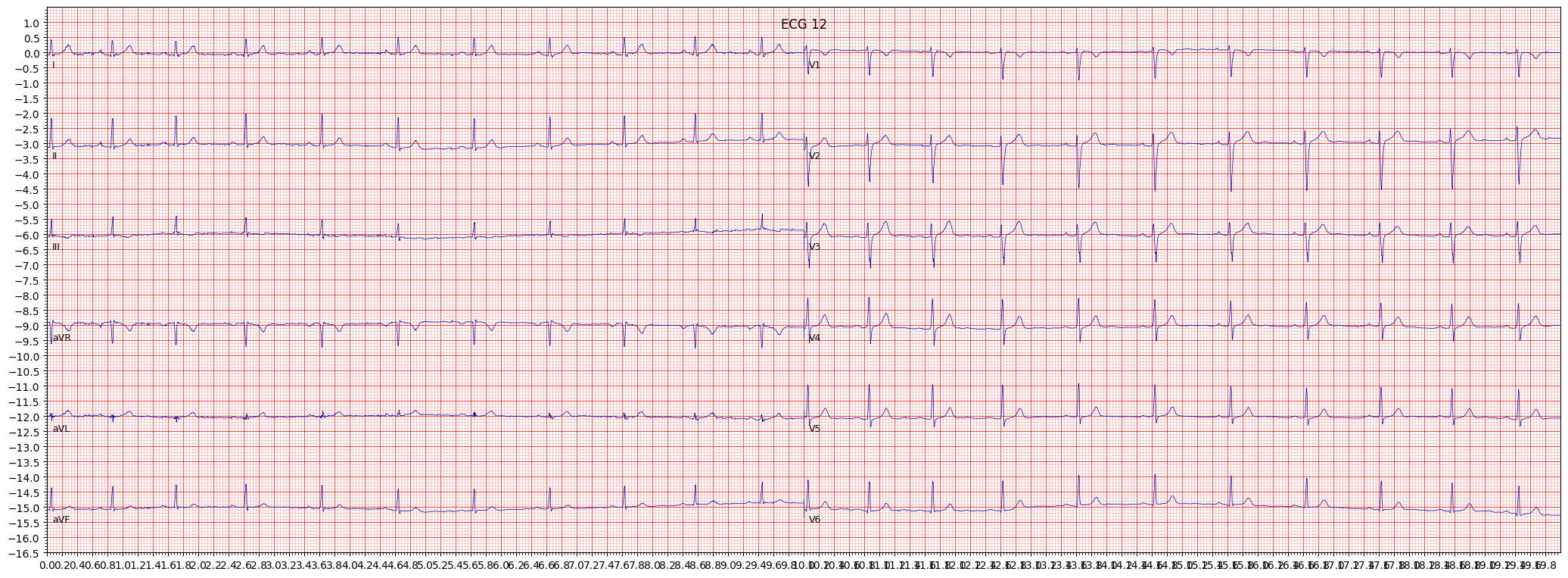 Examples Of Normal ECG NORM ECG Library Examples Of Normal ECG NORM ECG Library