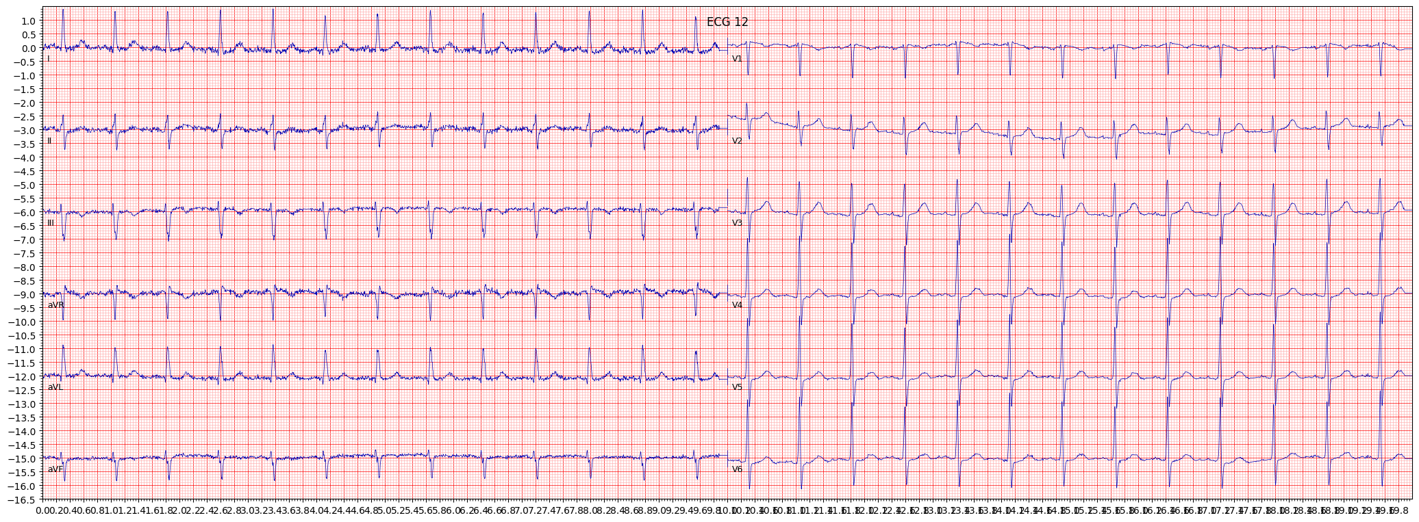ECG Diagnosis Practice - Learn ECG Analysis Online