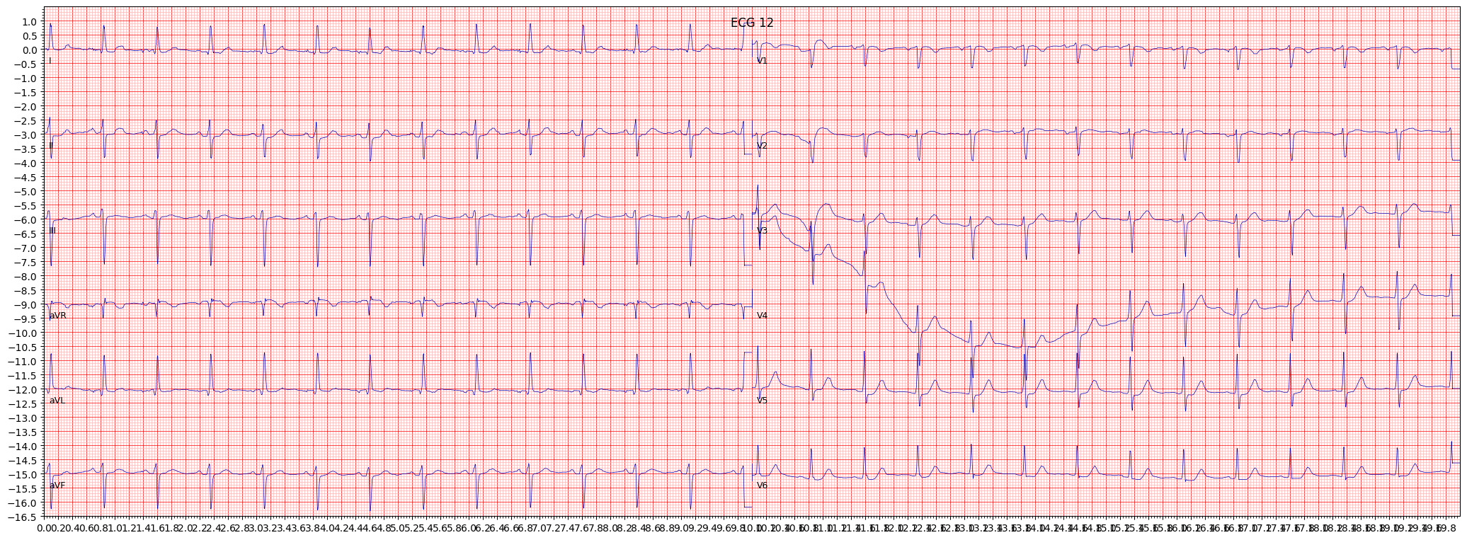 ECG Diagnosis Practice - Learn ECG Analysis Online