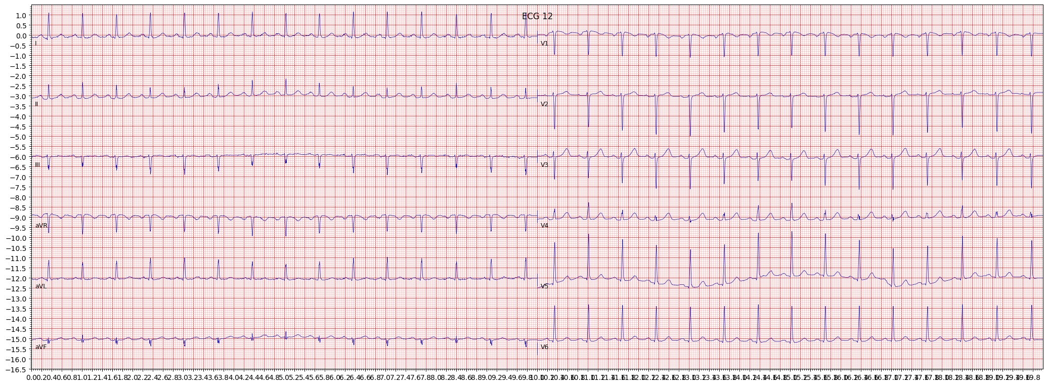 ECG Diagnosis Practice - Learn ECG Analysis Online