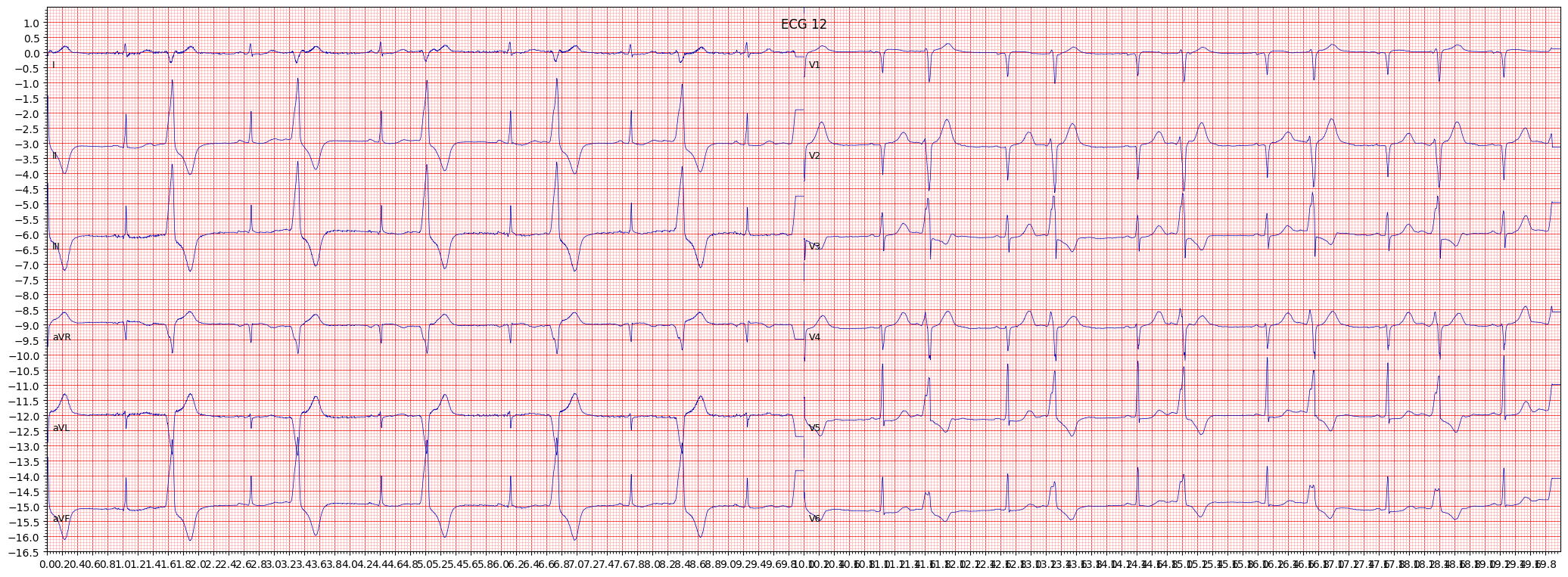 Examples Of Anteroseptal Myocardial Infarction ASMI ECG Library