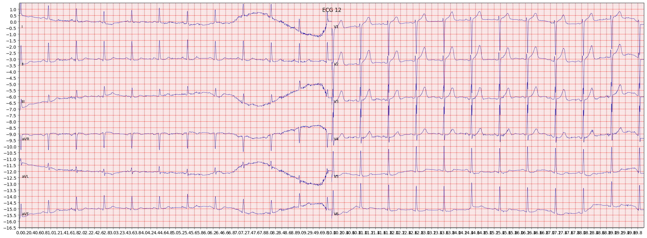 ECG Diagnosis Practice - Learn ECG Analysis Online