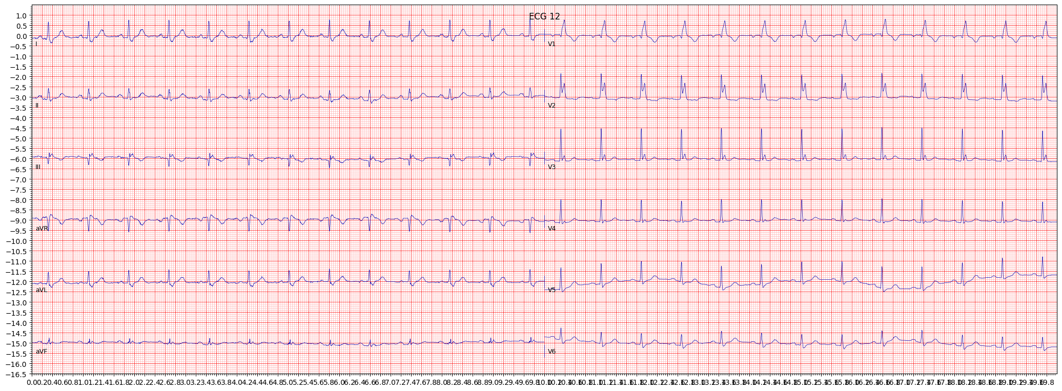 ECG Diagnosis Practice - Learn ECG Analysis Online
