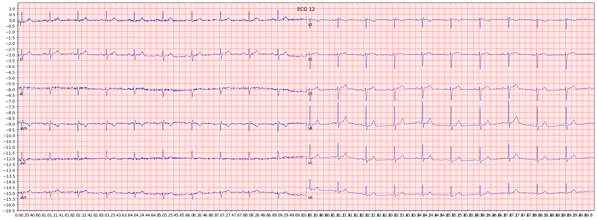 ECG Diagnosis Practice - Learn ECG Analysis Online