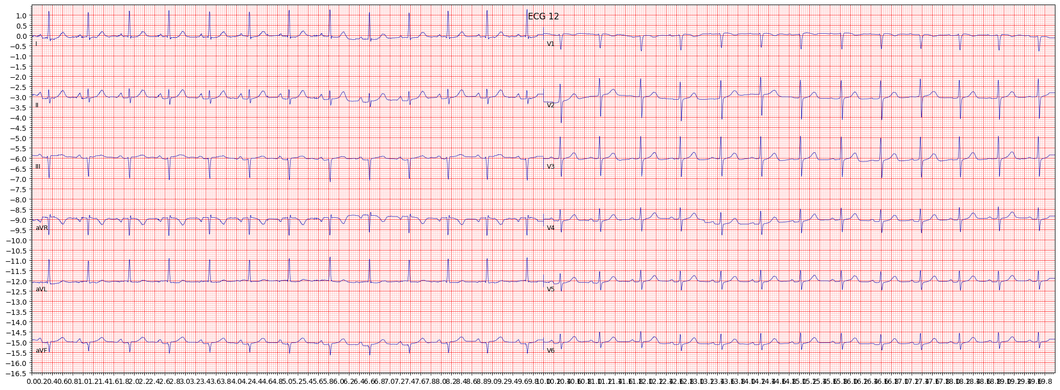 ECG Diagnosis Practice - Learn ECG Analysis Online