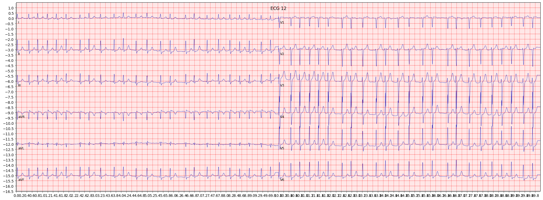 ECG Diagnosis Practice - Learn ECG Analysis Online