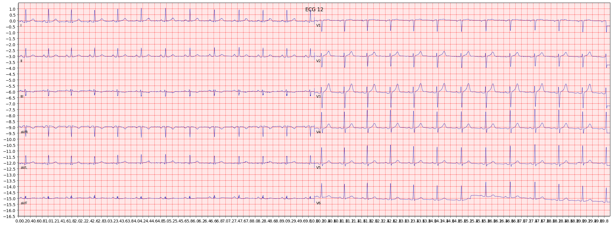 ECG Diagnosis Practice - Learn ECG Analysis Online