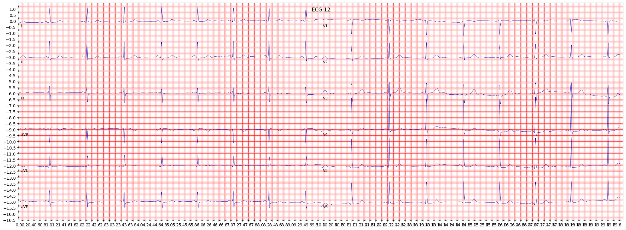ECG Diagnosis Practice - Learn ECG Analysis Online